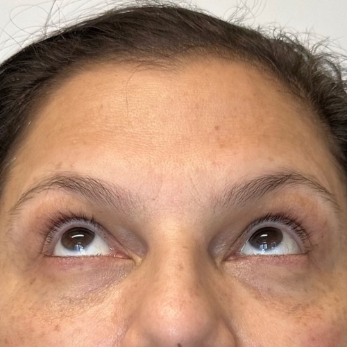 Tear Trough and Mid-Face Support - La Clinique Aesthetics