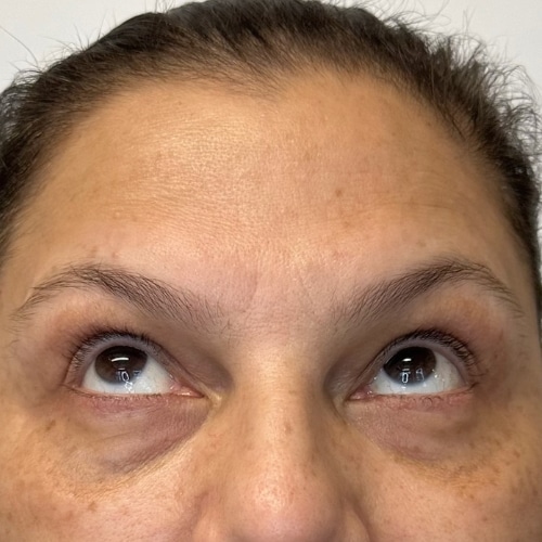 Tear Trough Archives - La Clinique Aesthetics