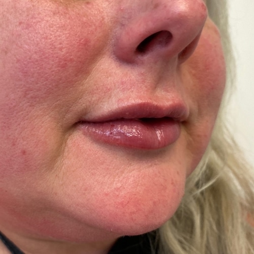 Lip Building Archives - La Clinique Aesthetics