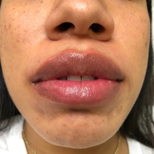 Lip Building - La Clinique Aesthetics