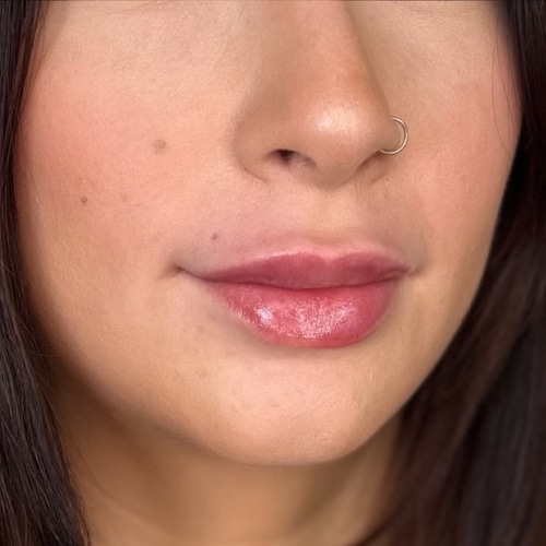 Lip Building - La Clinique Aesthetics