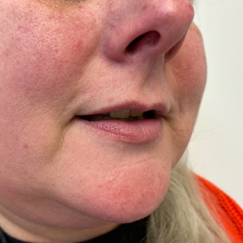 Lip Building Archives - La Clinique Aesthetics