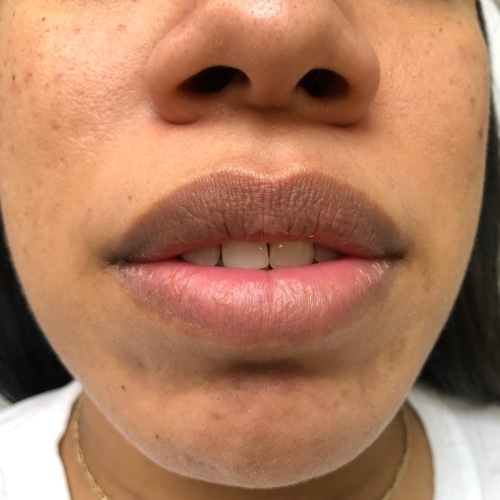 Lip Building - La Clinique Aesthetics